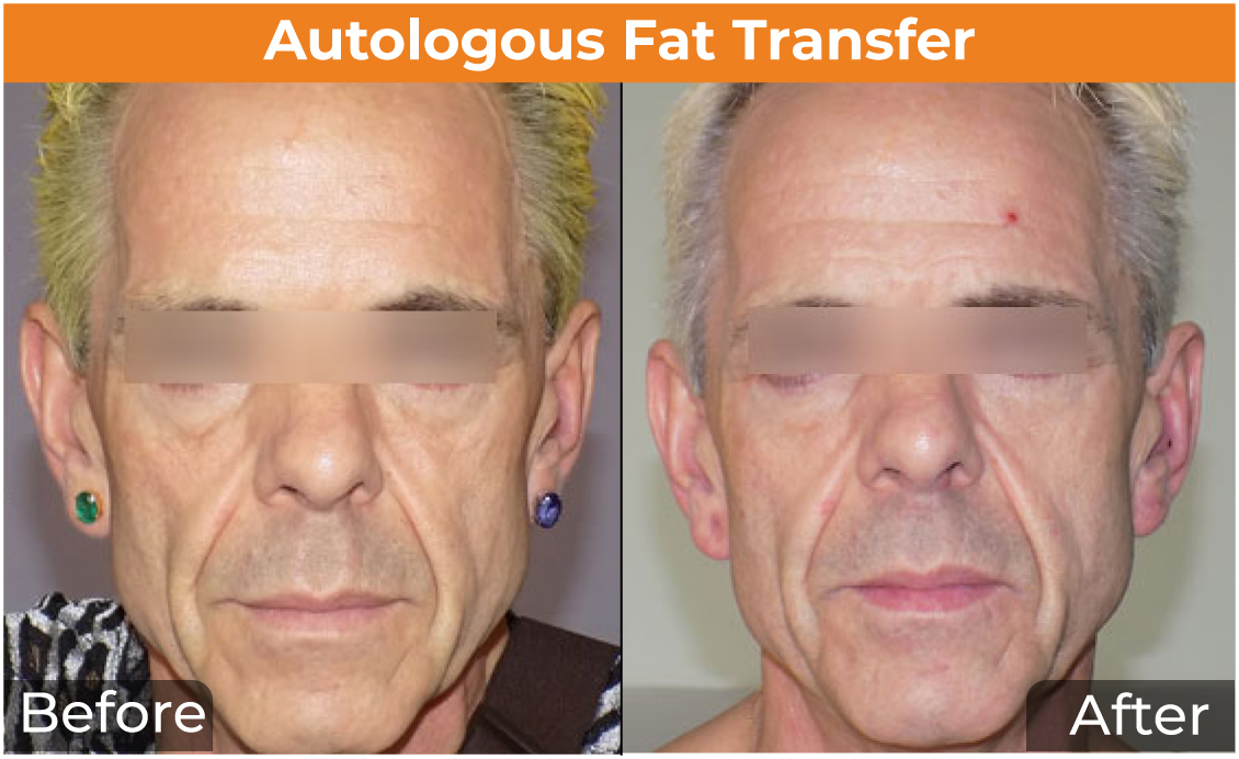Autologous Fat Transfer - The Esthetic Clinic